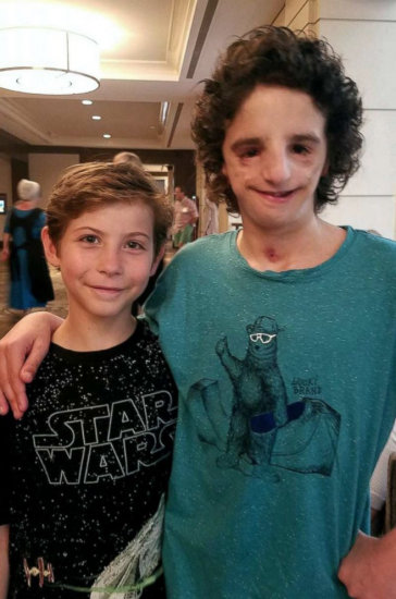 Disability Spotlight: Nathaniel Newman, Treacher Collins, & "Wonder ...